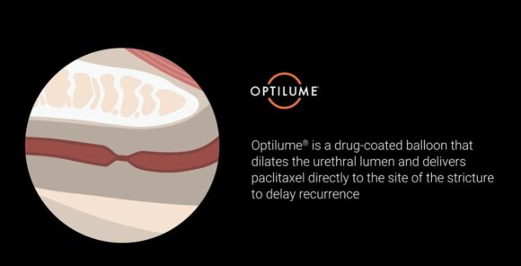 Optilume® | Urethral Drug Coated Balloon